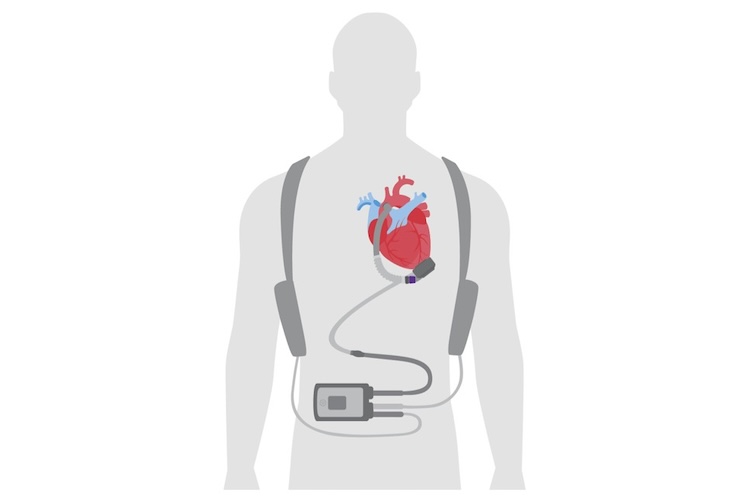 What to know about left ventricular assist devices | VCU Health