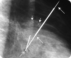 Preoperative Wire Localization | Breast Imaging | VCU Health